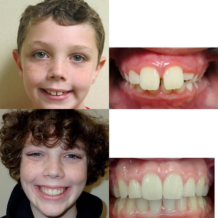 Crowded Teeth Before And After Braces